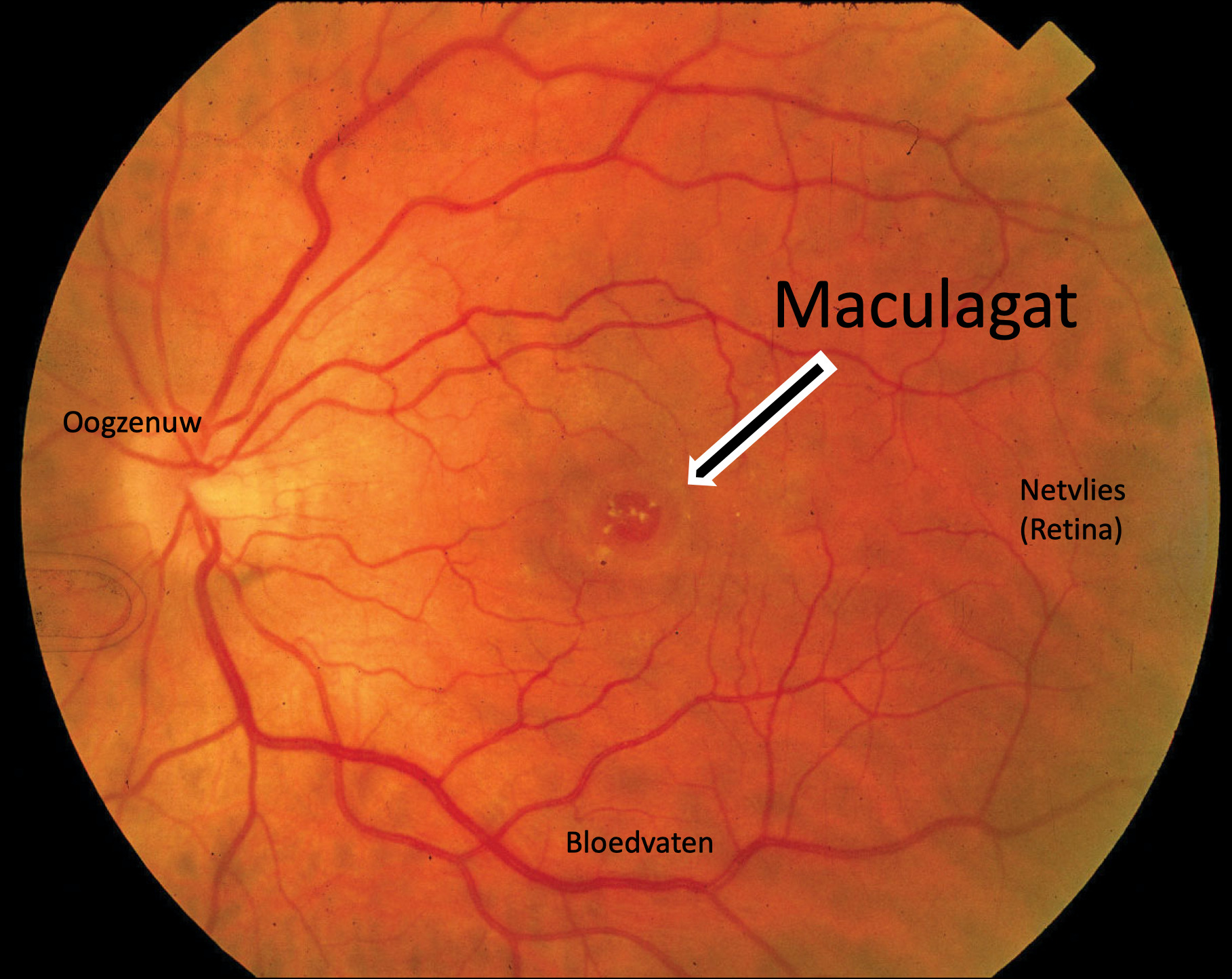 Maculagaatje | Spielberg Retina