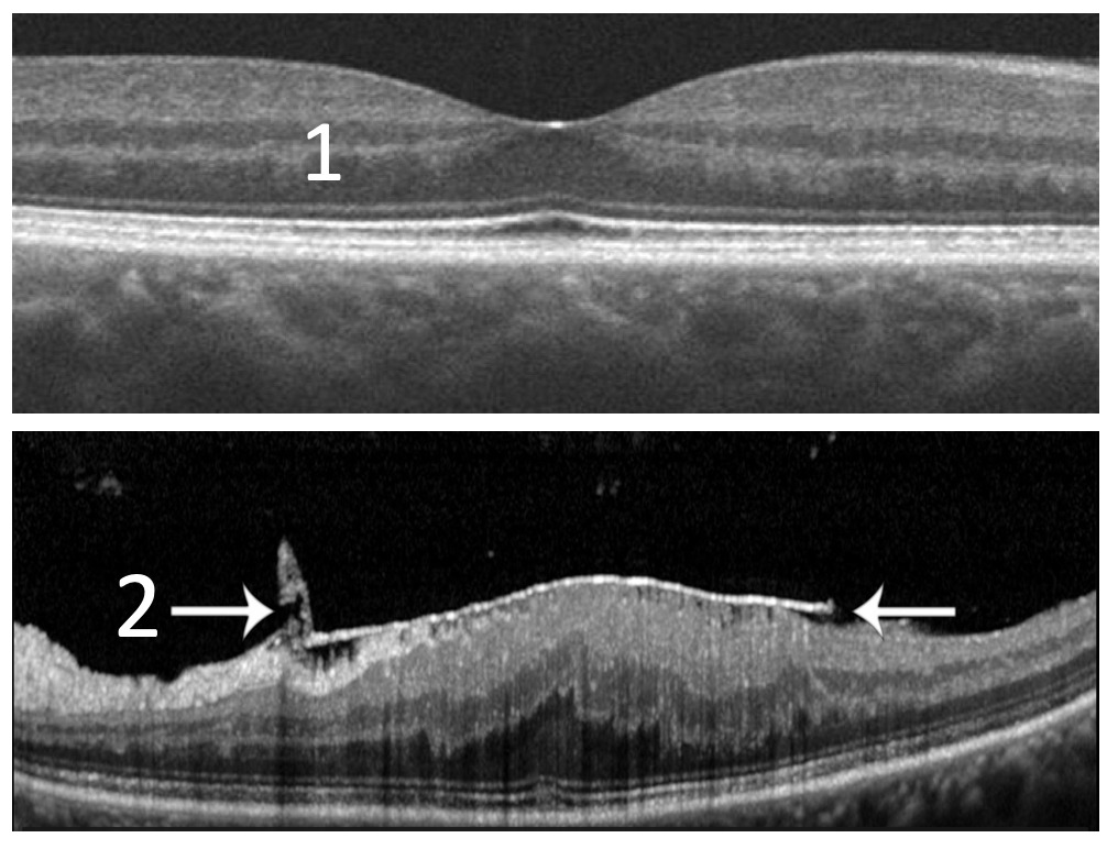 Macula Pucker | Spielberg Retina