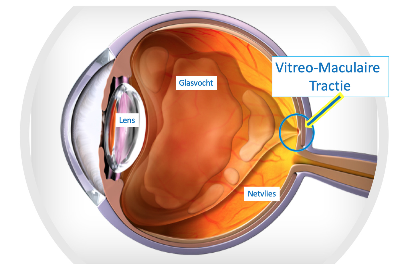 Vitreo-Maculaire Tractie (VMT) | Spielberg Retina